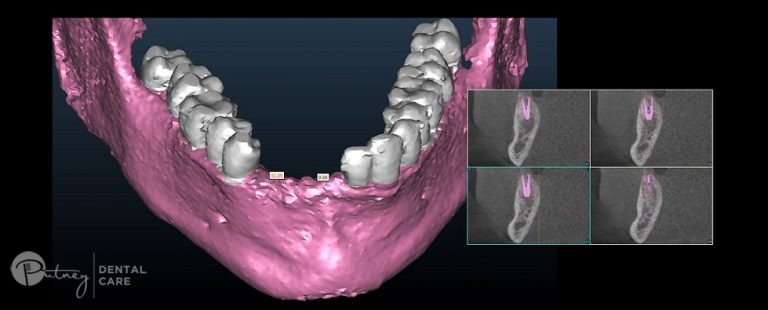 Cone Beam 3D Imaging - Putney Dental Care