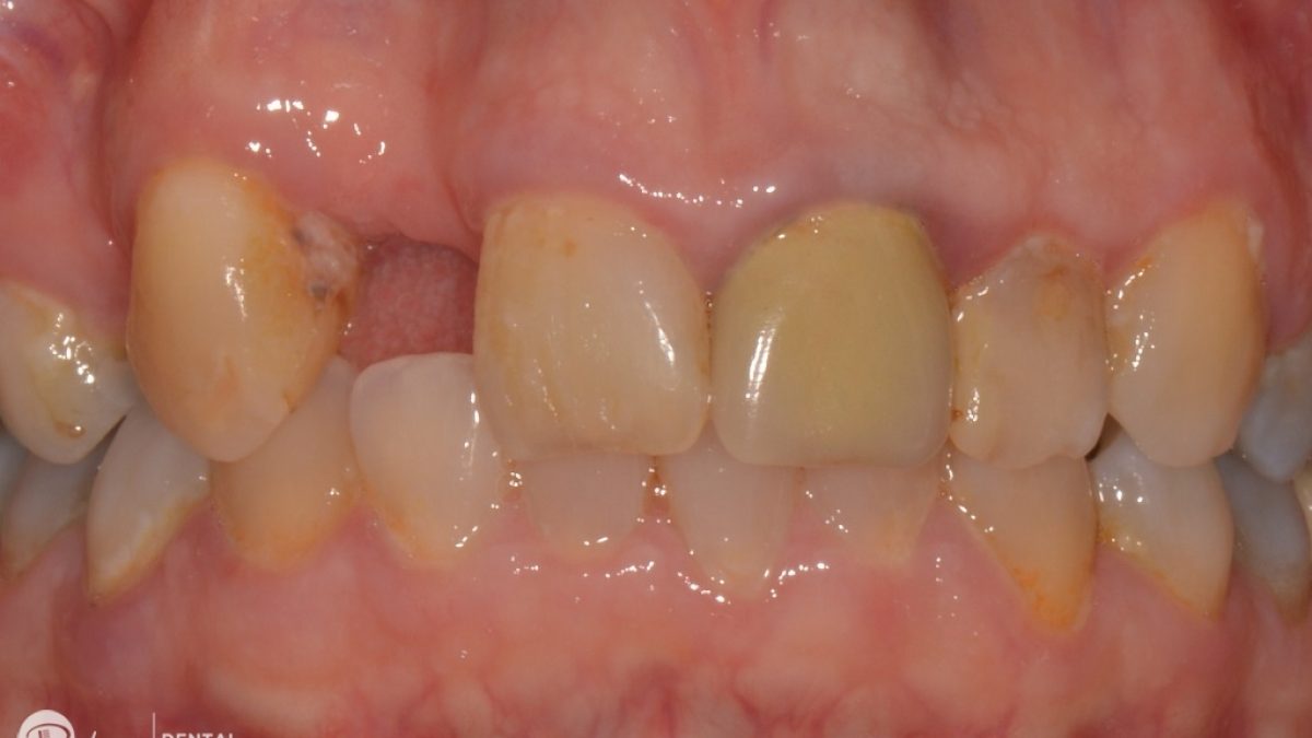 Hpv On Gums